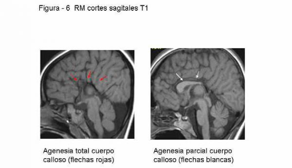 Diagnóstico por la imagen de la patología del cuerpo calloso en pediatría